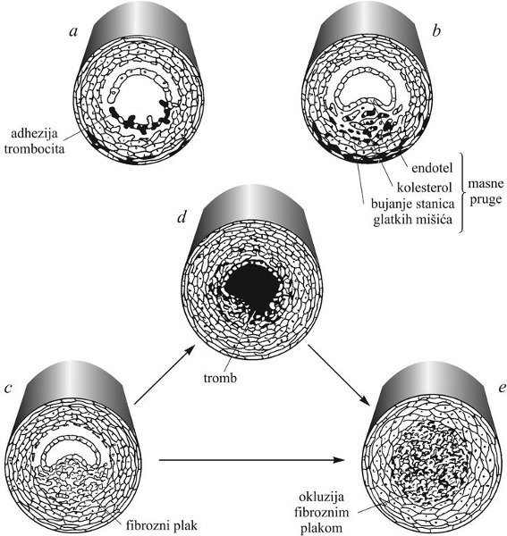 ateroskleroza - Hrvatska enciklopedija