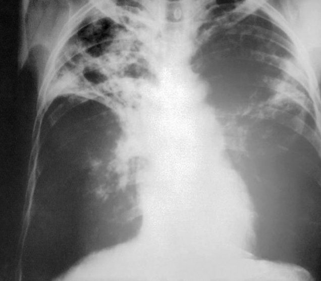 tuberkuloza - Hrvatska enciklopedija