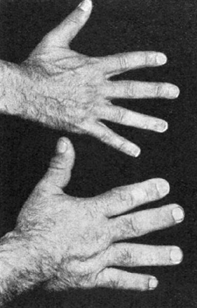 akromegalija - Hrvatska enciklopedija