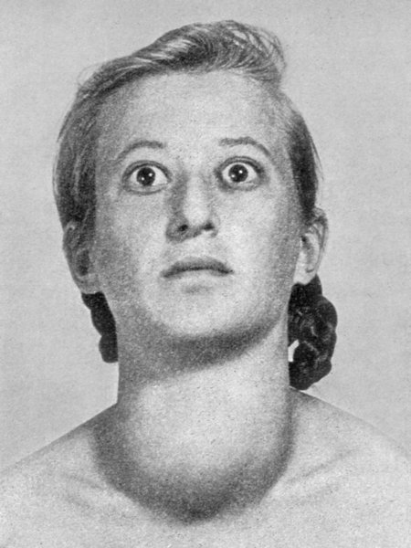 hipertireoza - Hrvatska enciklopedija