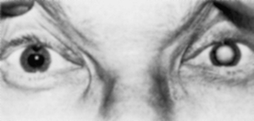 katarakta - Hrvatska enciklopedija