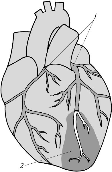 infarkt - Hrvatska enciklopedija