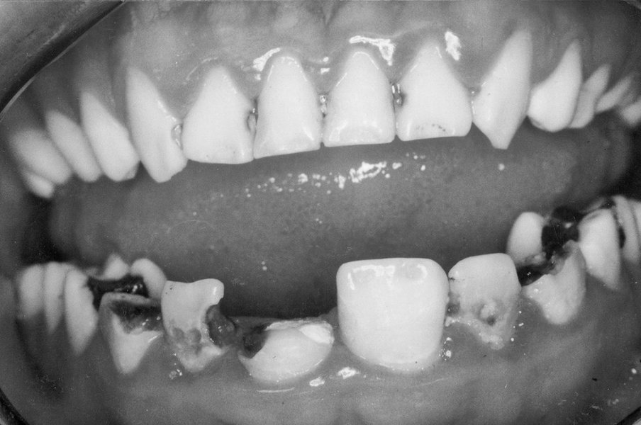 karijes - Hrvatska enciklopedija