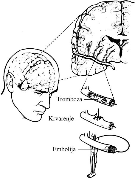 moždana kap - Hrvatska enciklopedija