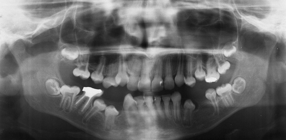 ortopantomogram - Hrvatska enciklopedija