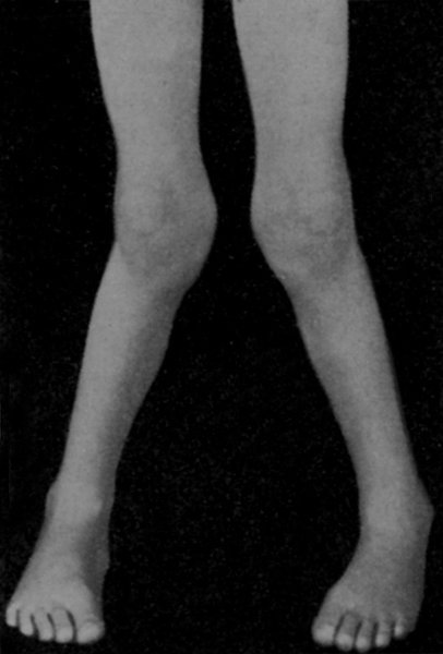 rahitis - Hrvatska enciklopedija