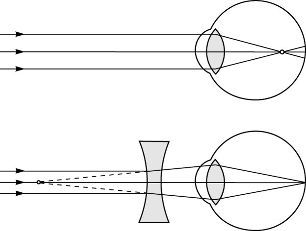 kratkovidnost - Hrvatska enciklopedija